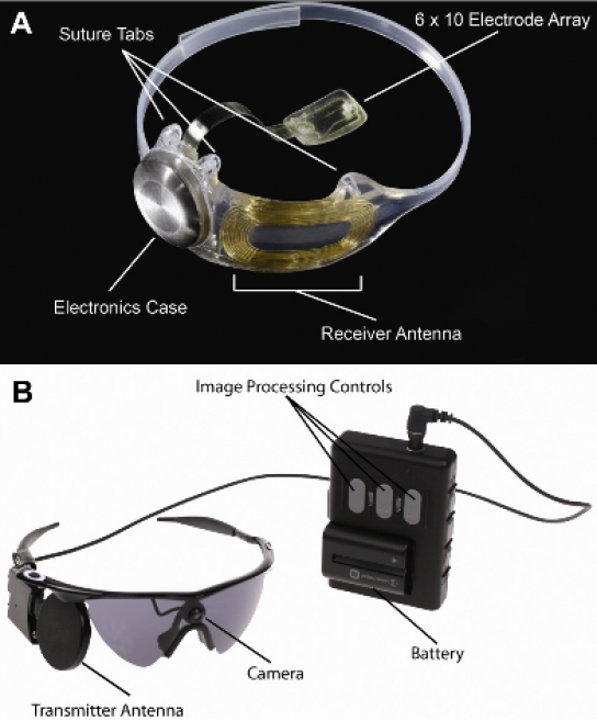 De nouveaux résultats encourageants pour l’Argus II | Acuité